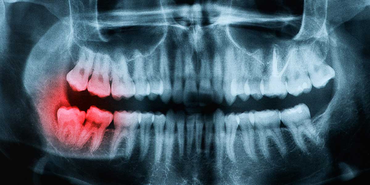 Dentoalveolar Surgery in Thousand Oaks, California | Lombard Dental Studio