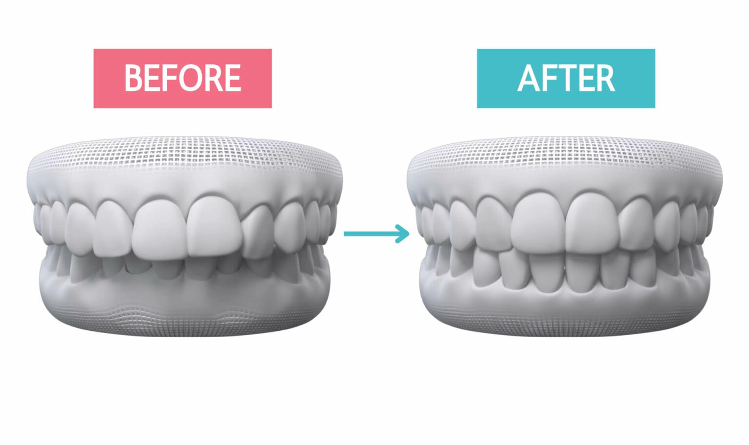 Overbite: Causes & Modern Treatment Options | Thousand Oaks Dental Studio