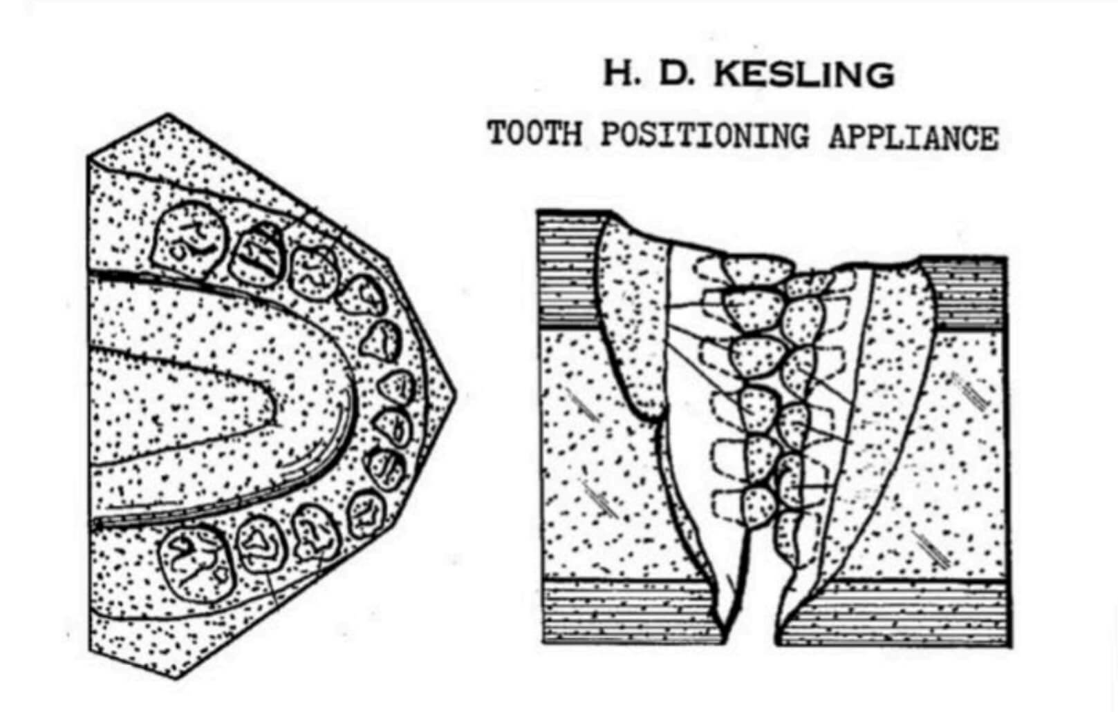 Evolution of Clear Aligners: From 1945 tooth positioner to AI-driven ...