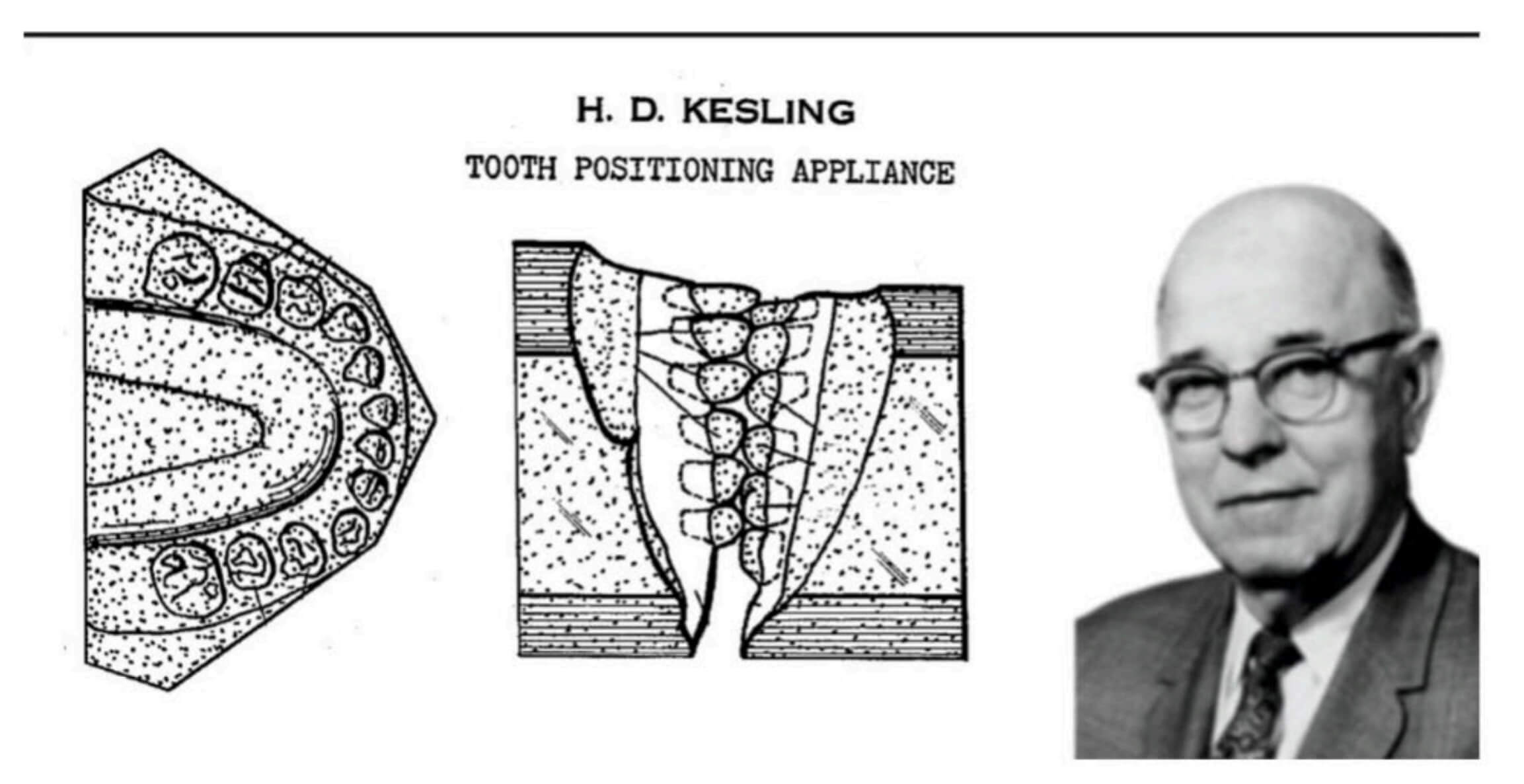 Evolution of Clear Aligners: From 1945 tooth positioner to AI-driven ...