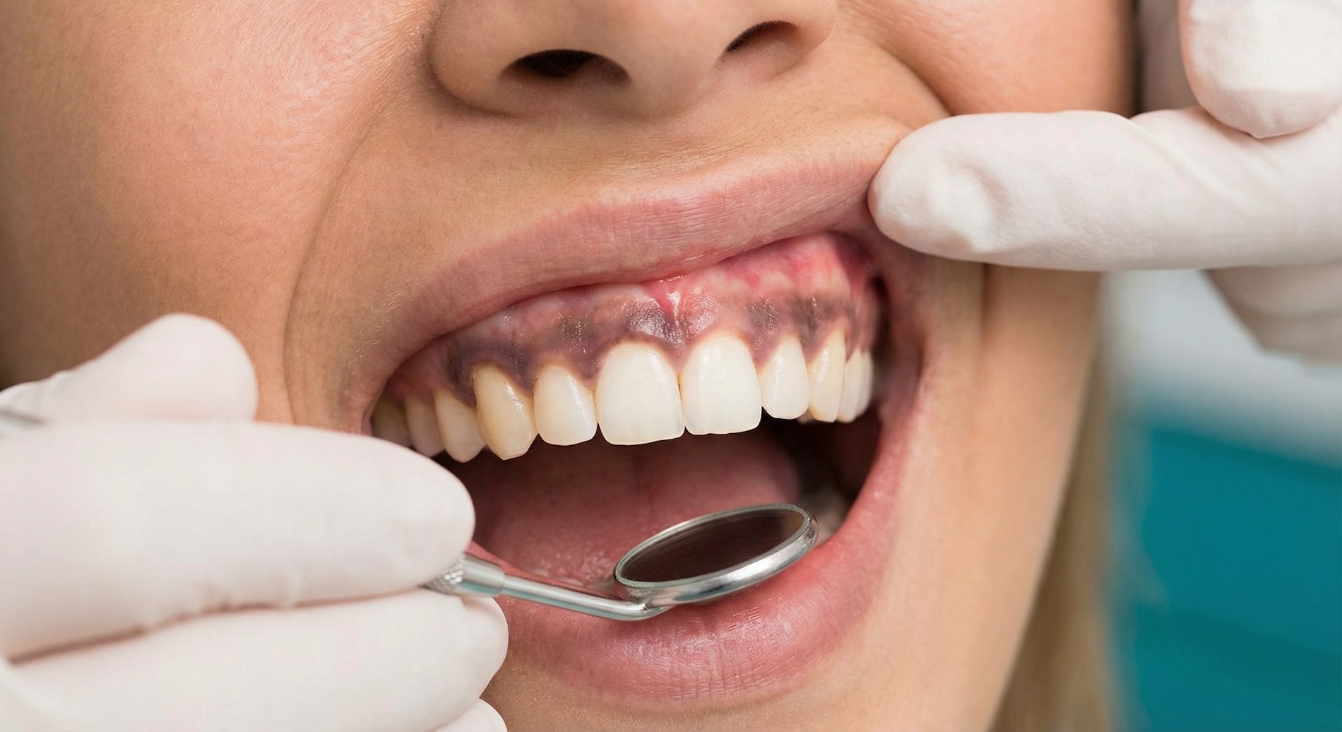 Understanding Black or Dark Gums: Causes, Risks, and How to Restore a ...